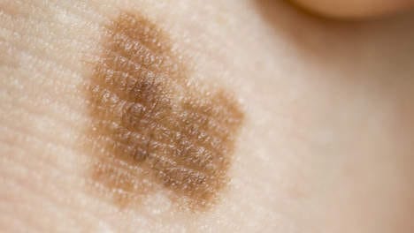 Huidkanker herkennen en behandelen | Nieuws | Menselijk Lichaam