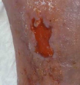 Ulcus cruris | Algemeen | Menselijk Lichaam