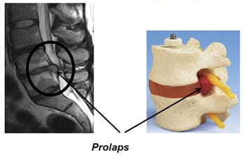 Prolaps | Algemeen | Menselijk Lichaam