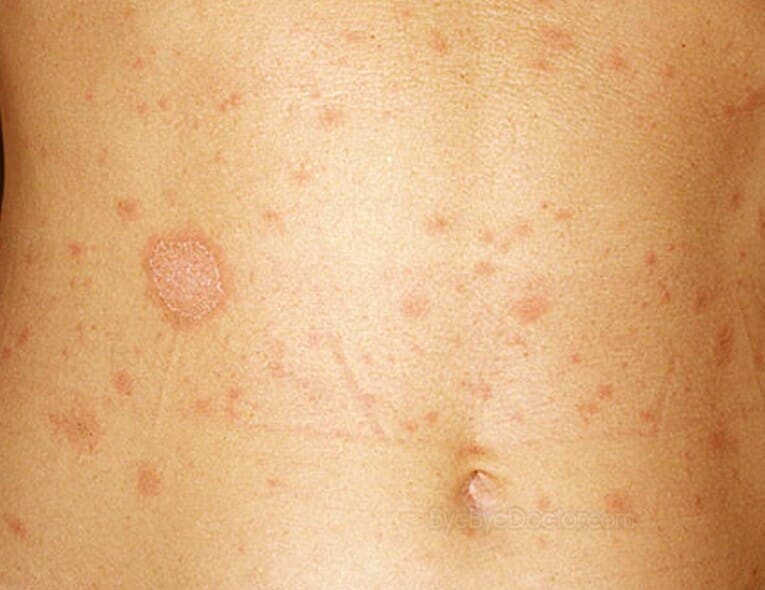 Pityriasis rosea | Huid | Menselijk Lichaam