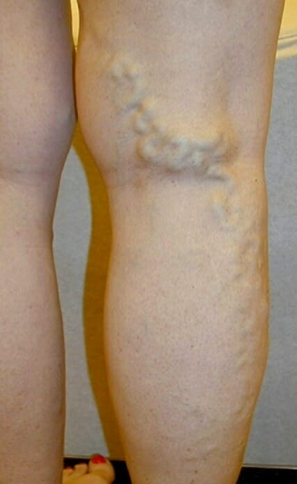 Aderontsteking | Algemeen | Menselijk Lichaam