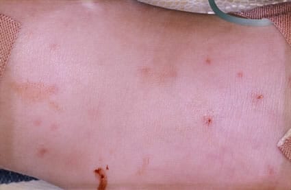 Bloedvergiftiging | Algemeen | Menselijk Lichaam