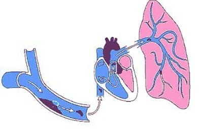 Embolie | Algemeen | Menselijk Lichaam