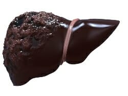 Levercirrose | Spijsvertering | Menselijk Lichaam