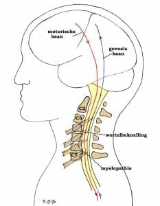 Spastische verlamming | Hersenen | Menselijk Lichaam